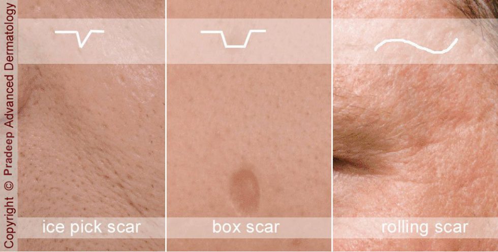Acne Scars | Dermatologist